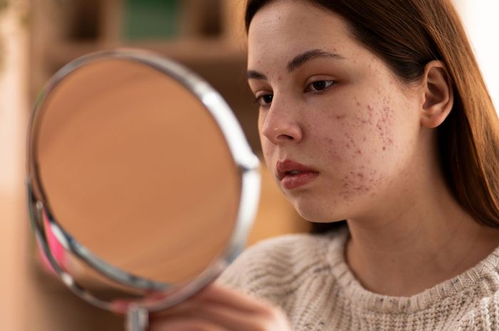 Tips Ampuh Hilangkan Bekas Jerawat secara Alami dan Efektif - Ntvnews.id